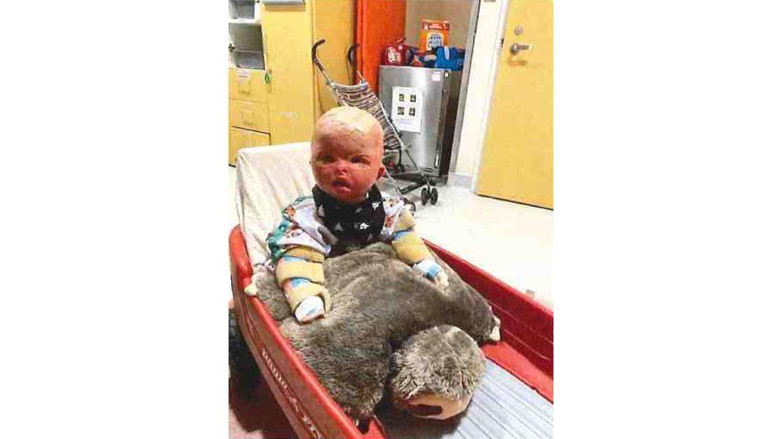 WA failed to protect baby disfigured in shed fire, lawsuit claims ...